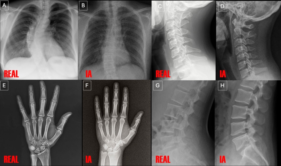 Las radiografías hechas con ChatGPT engañan a radiólogos